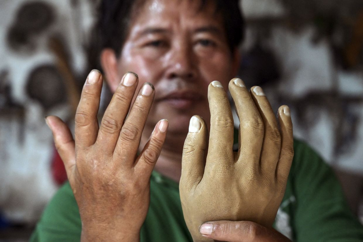 Leprosy survivor crafts new limbs for shunned villagers - Mon, January ...